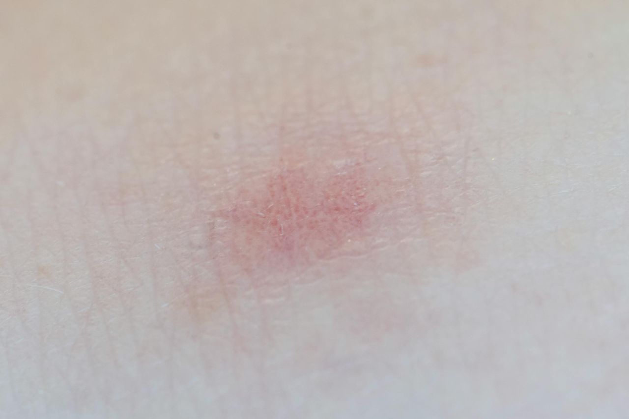 Аллергия на холод на руках: как распознать и защитить кожу